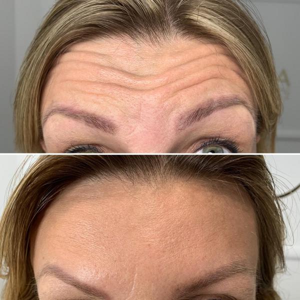 Botox